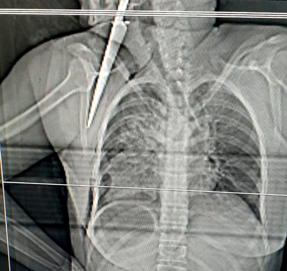 Ex-companheiro ataca mulher e deixa faca cravada em seu tórax